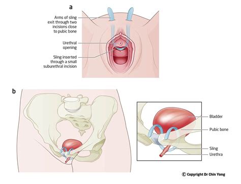 Bladder Prolapse After Bladder Sling