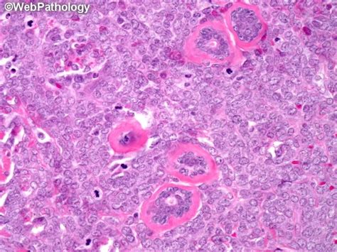 Myeloid Sarcoma Breast