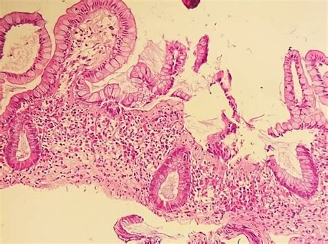 Duodenal Mucosa With Severe Villous Atrophy Subepithelial Collagen