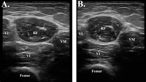 SEX DIFFERENCES IN RECTUS FEMORIS MORPHOLOGY ACROSS DIFFERENT KNEE