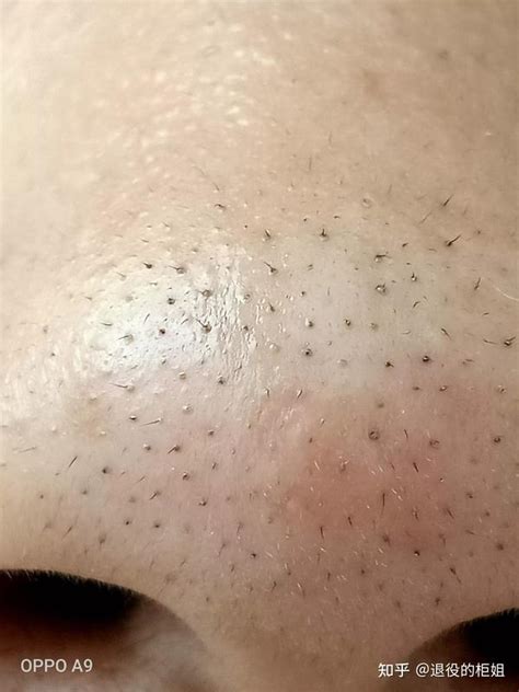 黑头上面还长出毛来该怎么办？毳毛型黑头是什么？ 知乎