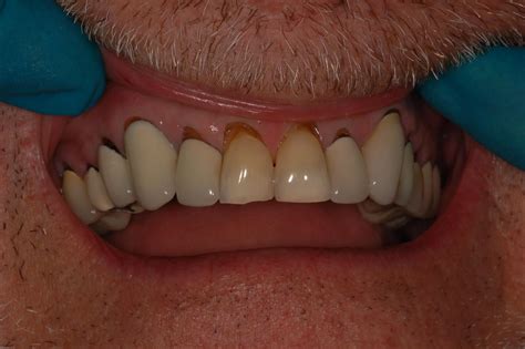 Mouth Breather Long In The Tooth Common Dental Phrases