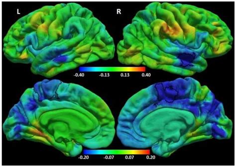 Colour Map Of Regression Coefficients For Local Gyrification Index