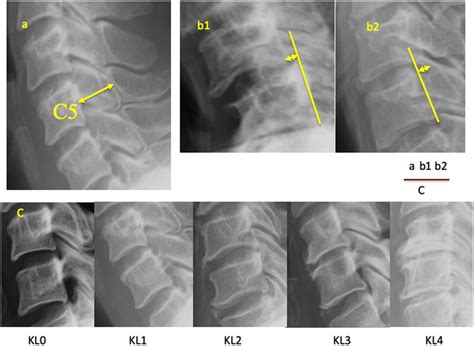 Normal Cervical Spine Radiographs Image Radiopaediaorg