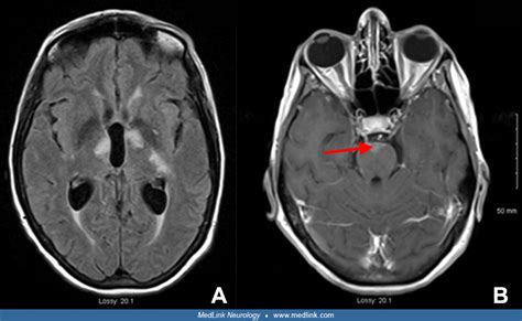 Cryptococcus Brain