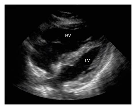Cardiac Ultrasound Subxiphoid View Showing A Dilated Right Ventricle Rv Download