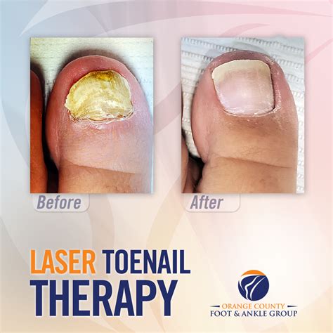 Orange Fungal Toenail Therapy Is Available Now At Ocfa Three Offices