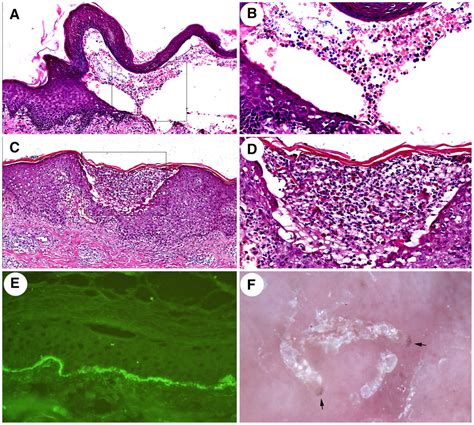 Bullous Impetigo Histology