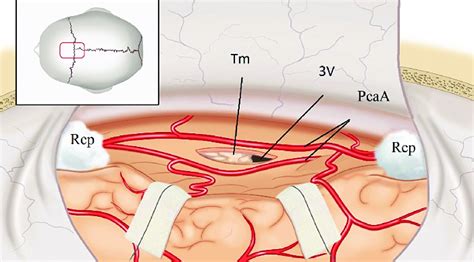 Schematic Illustration Of The Positioning And Surgical Corridor Download Scientific Diagram