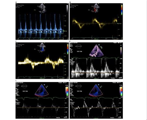 Mitral Inflow And Tissue Doppler Velocities Pre And Download Scientific Diagram