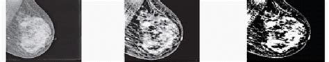 Mammogram Image Segmentation A Original Image B Proposed
