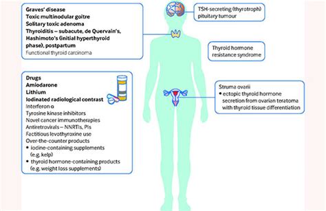 Hyperthyroidism Concept Map Nursing