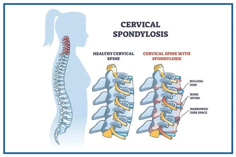 Cervical Spondylosis