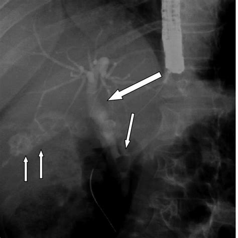 Ercp Showing The Remnant Cystic Duct With A Stone Impacted In It Download Scientific Diagram