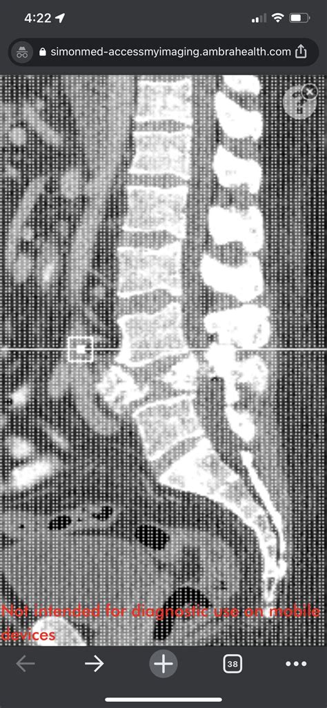L4 Compression Fracture How Fed Am I Really Medical