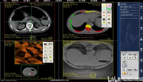 Pacs系统源码，支持三维重建、三维虚拟内窥镜、心脏动脉钙化分析等功能 哔哩哔哩