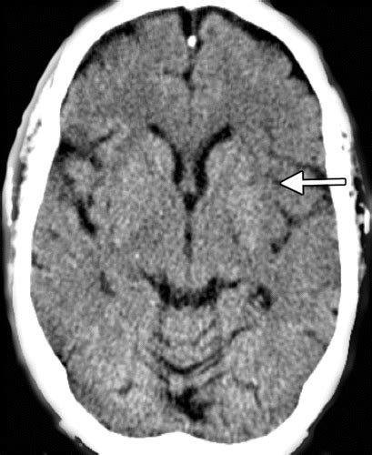 Stroke Ct Scan Stroke Ct Scan