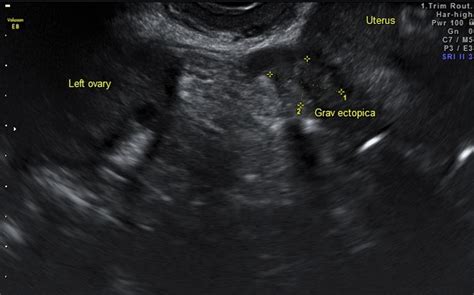 Transvaginal Ultrasonography Demonstrated A Heteroechoic Area In The Download Scientific