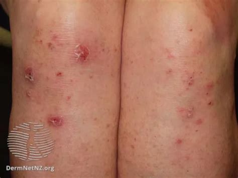 Extensor Surfaces Location And Common Skin Conditions