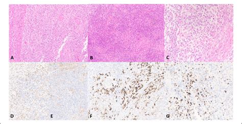 Testicular Sarcomatoid Spermatocytic Tumor Solid And Diffuse Areas Of Download Scientific