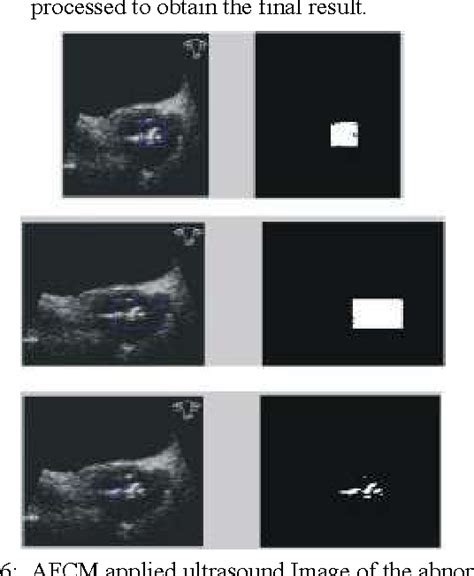Figure 1 From Ultrasound Cervical Cancer Based Abnormality Segmentation Using Adaptive Fuzzy C