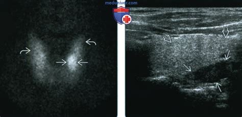 Аденома паращитовидной железы в висцеральном пространстве лучевая диагностика