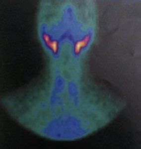 Isotope Scan Of The Thyroid