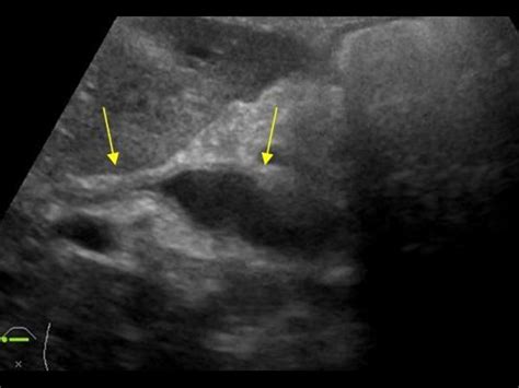 Abdomen And Retroperitoneum 1 2 Gallbladder And Bile Ducts Case 1 2 18 Bile Duct