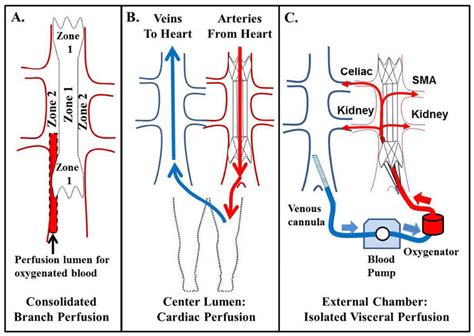 An Organ Perfusion Stent Compartmentalizes Blood Flow A An Ops