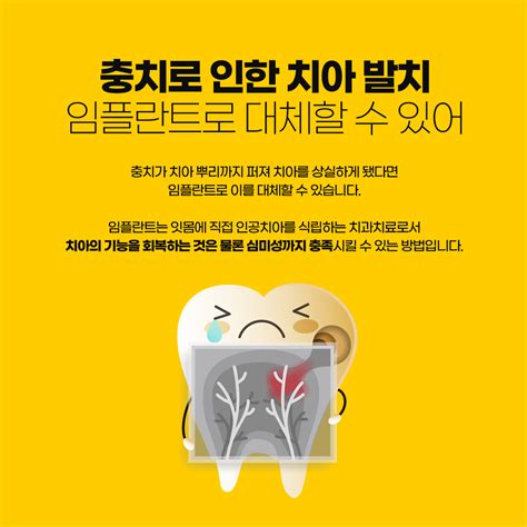 임플란트 충치가 원인이 될수도 치아 상실 대체하는 치과 임플란트 네이버 포스트