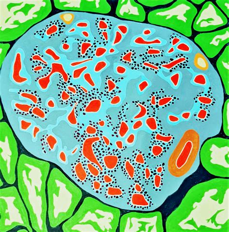 Segmental Membranous Glomerulopathy Art Of Medicine Arkana