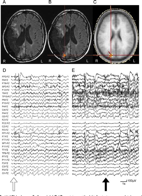 Figure 5 From Paradoxical Lateralization Of Non Invasive Electroencephalographic Ictal Patterns