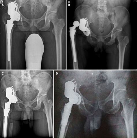 Offset Restoration In Total Hip Arthroplasty Important A Current Review Pmc