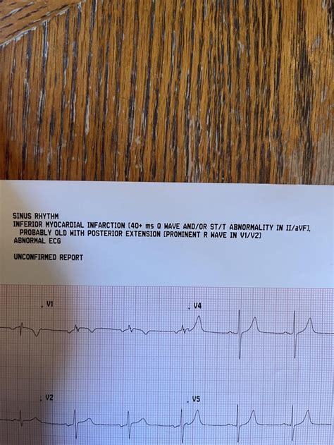 Explanation On Dads Ecg Thank U R Askcardiology