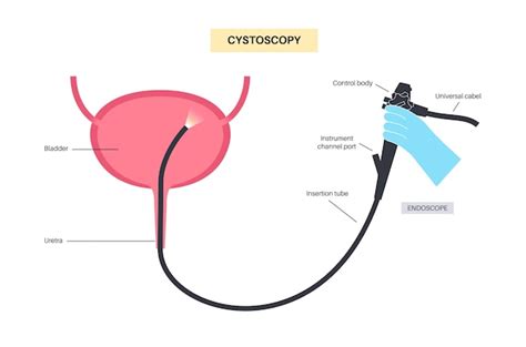 Premium Vector Cystoscopy Is A Minimally Invasive Procedure Examination And Treatment Of The