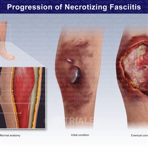 Progression Of Necrotizing Fasciitis Trialquest Inc