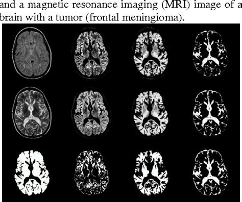 Figure 1 From Mri Image Segmentation Using Gradient Based Watershed Transform In Level Set