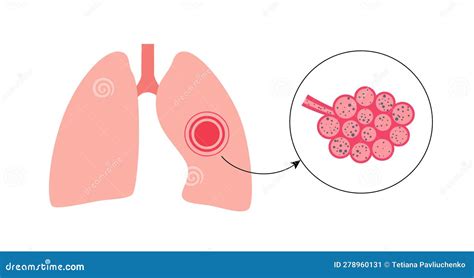 Pneumoconiosis Lung Disease Stock Vector Illustration Of Occupational Disease 278960131