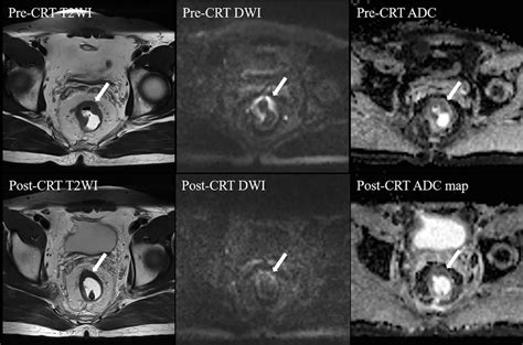Mri Tumor Regression Grade 2 In A 43 Year Old Man After Neo Crt Download Scientific Diagram
