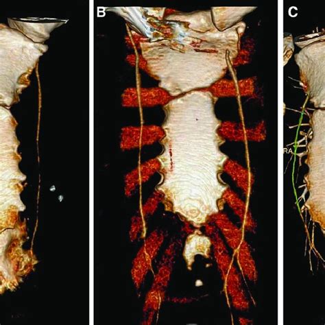Three Dimensional Reconstitution Of Preoperative Chest Cta Download Scientific Diagram