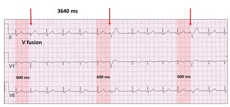 Unusual Ventricular Ectopy