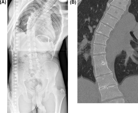 Disc Space Narrowing And Osteophytes Anesthesia Key