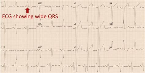 What Is The Difference Between Crt P And Crt D All About Heart And
