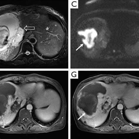 Enhanced Mri Images A 134×116 Cm Mass Blank Arrow With