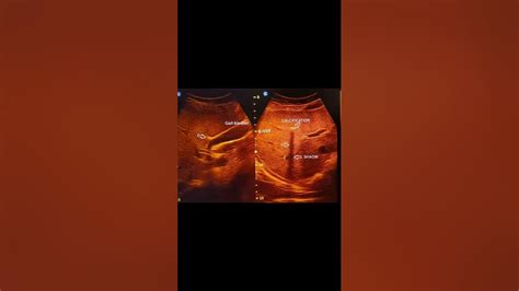 Hepatic Calcification Youtube