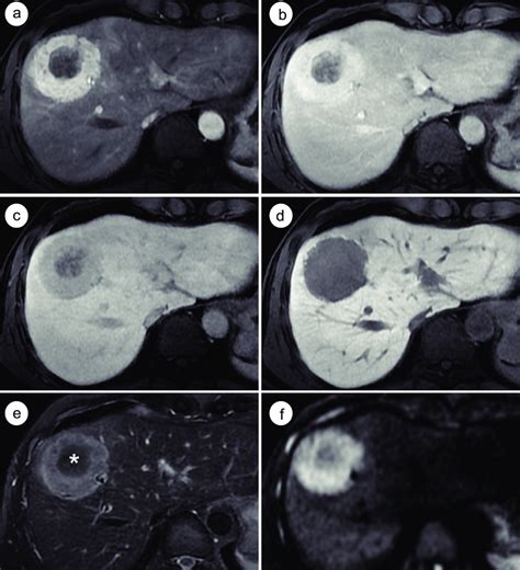 Mass Forming Type Icc Which Mimics The Enhancement Pattern Of Hcc On Download Scientific