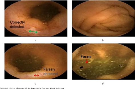 Figure 14 From Multi Scale Analysis Of Ulcer Disease Detection From Wce