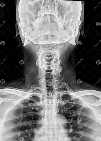 Xray Cspine Eller Xray Image Of Cervix Spinine Lateral View For Diagnostic Intervertebral Disk