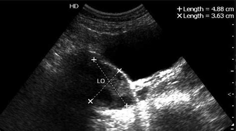 Hyperreactio Luteinalis An Often Mistaken Diagnosis Pmc