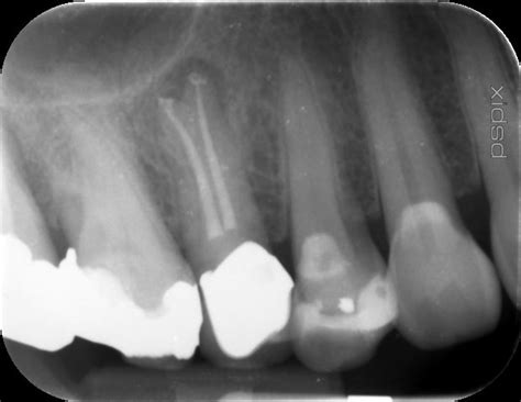 Root Canal Retreatment Of A Premolar With Periapical Pathology And